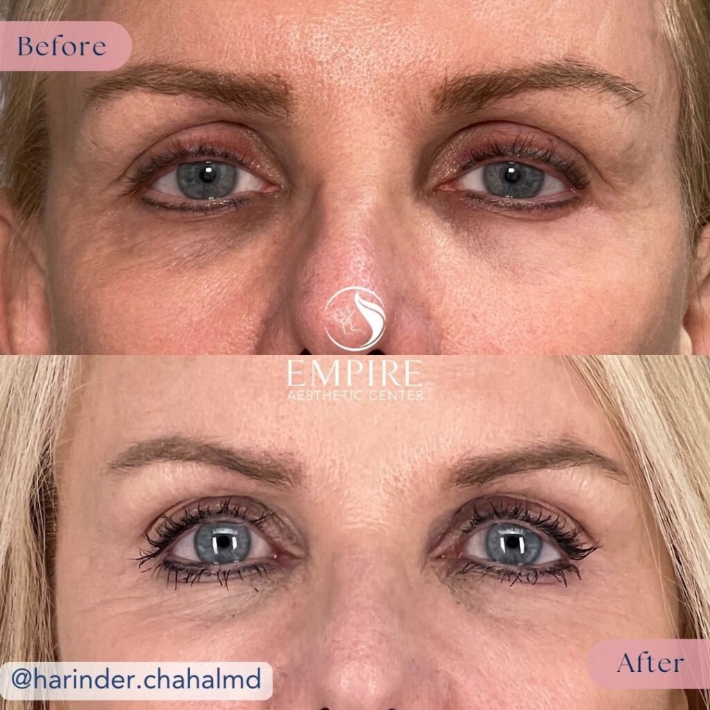 Before & After Gallery - Empire Aesthetic Center