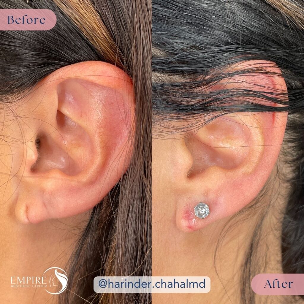 Before & After Gallery - Empire Aesthetic Center